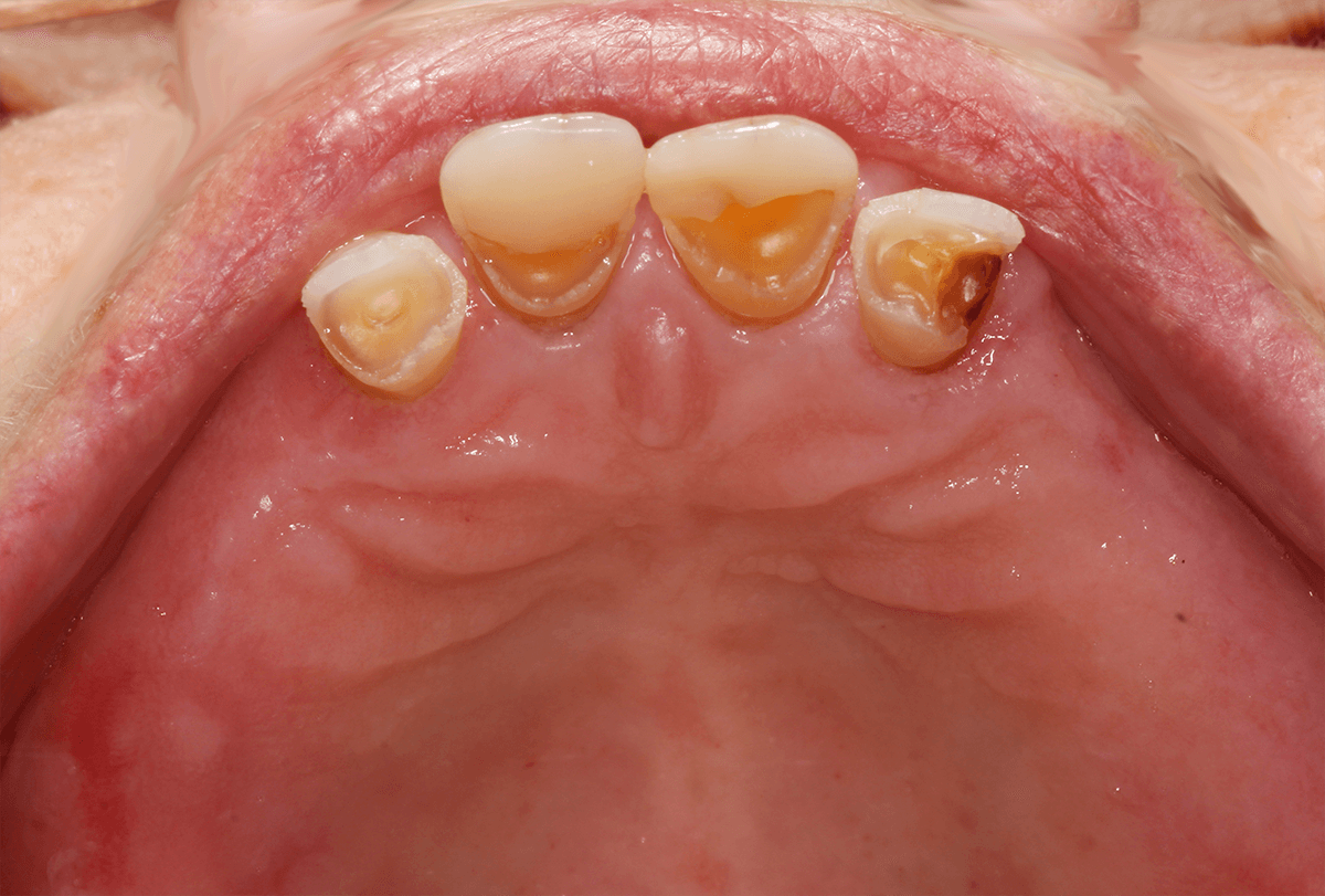 Multiple tooth implants | Lifestyle Dental Studio